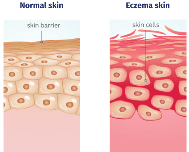 What Is Atopic Dermatitis Eczema Adbry®