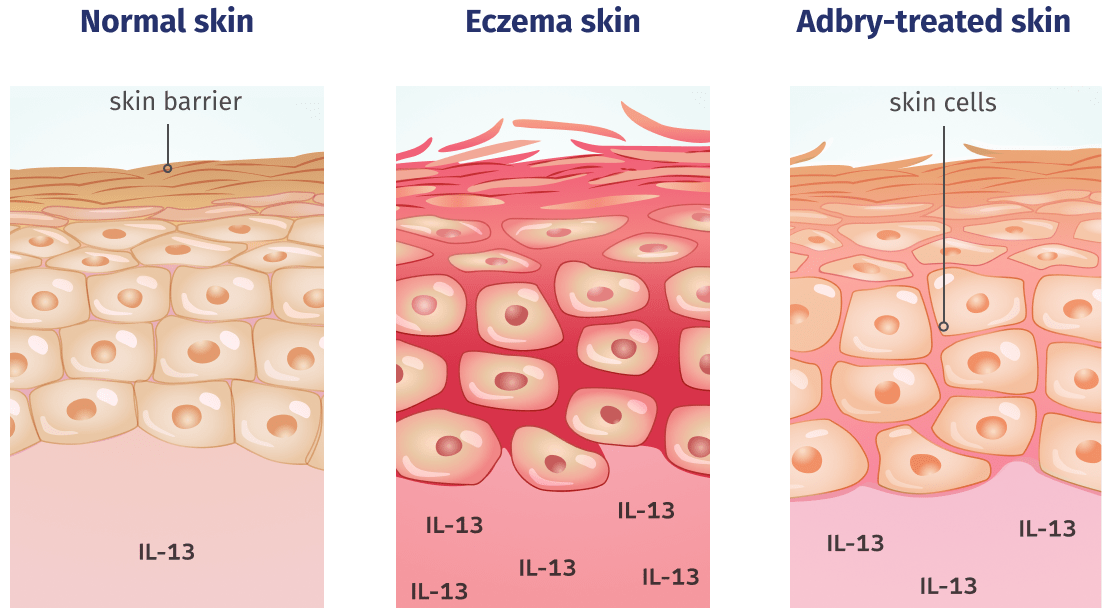 How Adbry® Works | Biologic Treatment for Eczema Inflammation