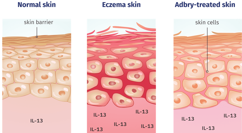 How Adbry® Works | Biologic Treatment for Eczema Inflammation