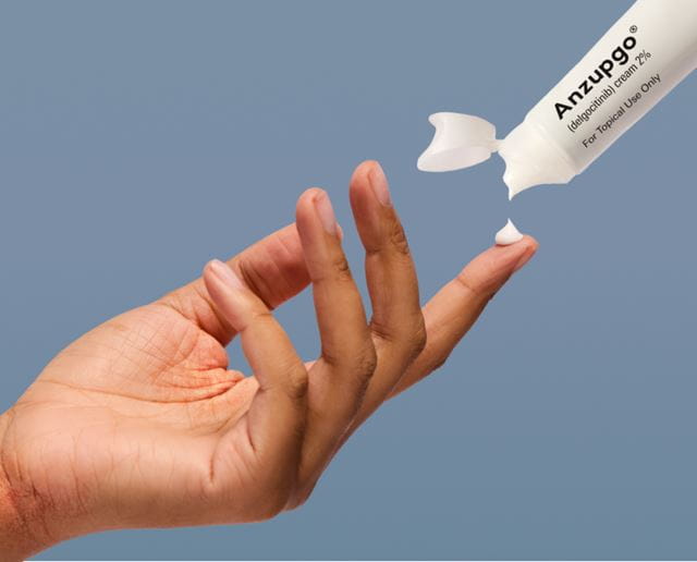 hand dermatitis cream